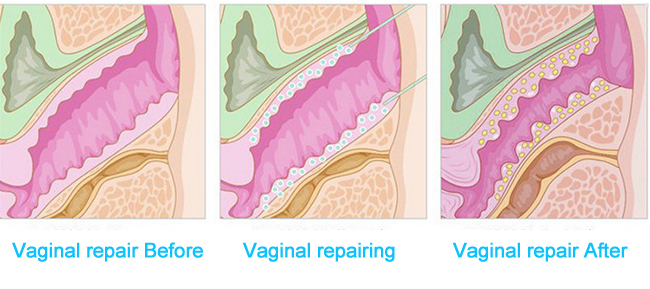 Hifu Vaginal Tighten Skin Rejuvenation 2 In 1 Machine For Lady Use
